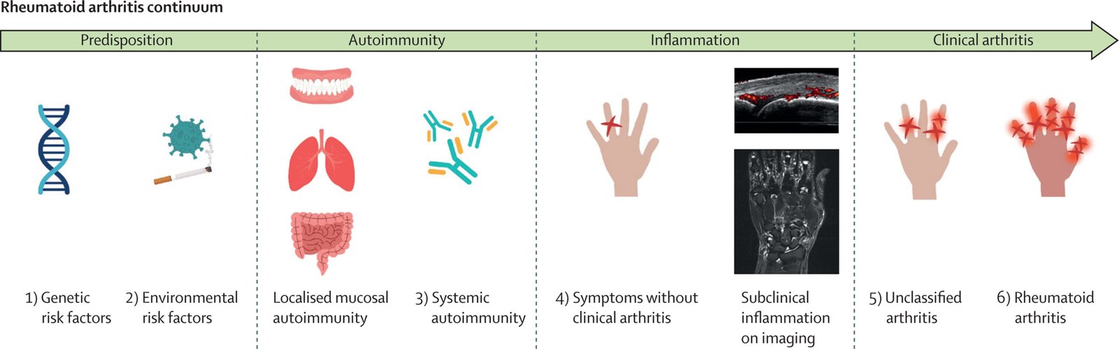 what are the 4 stages of rheumatoid arthritis - Readspot